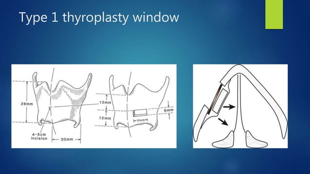 Laryngeal framework surgery | PPTX