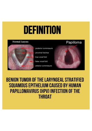 Laryngeal papillomatosis .pdf ENT BY QUICKMEDTALK | PDF