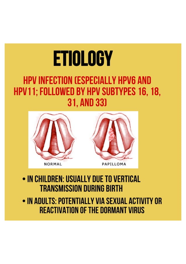 Laryngeal papillomatosis .pdf ENT BY QUICKMEDTALK | PDF