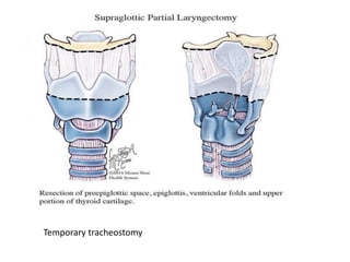 Partial Laryngectomy