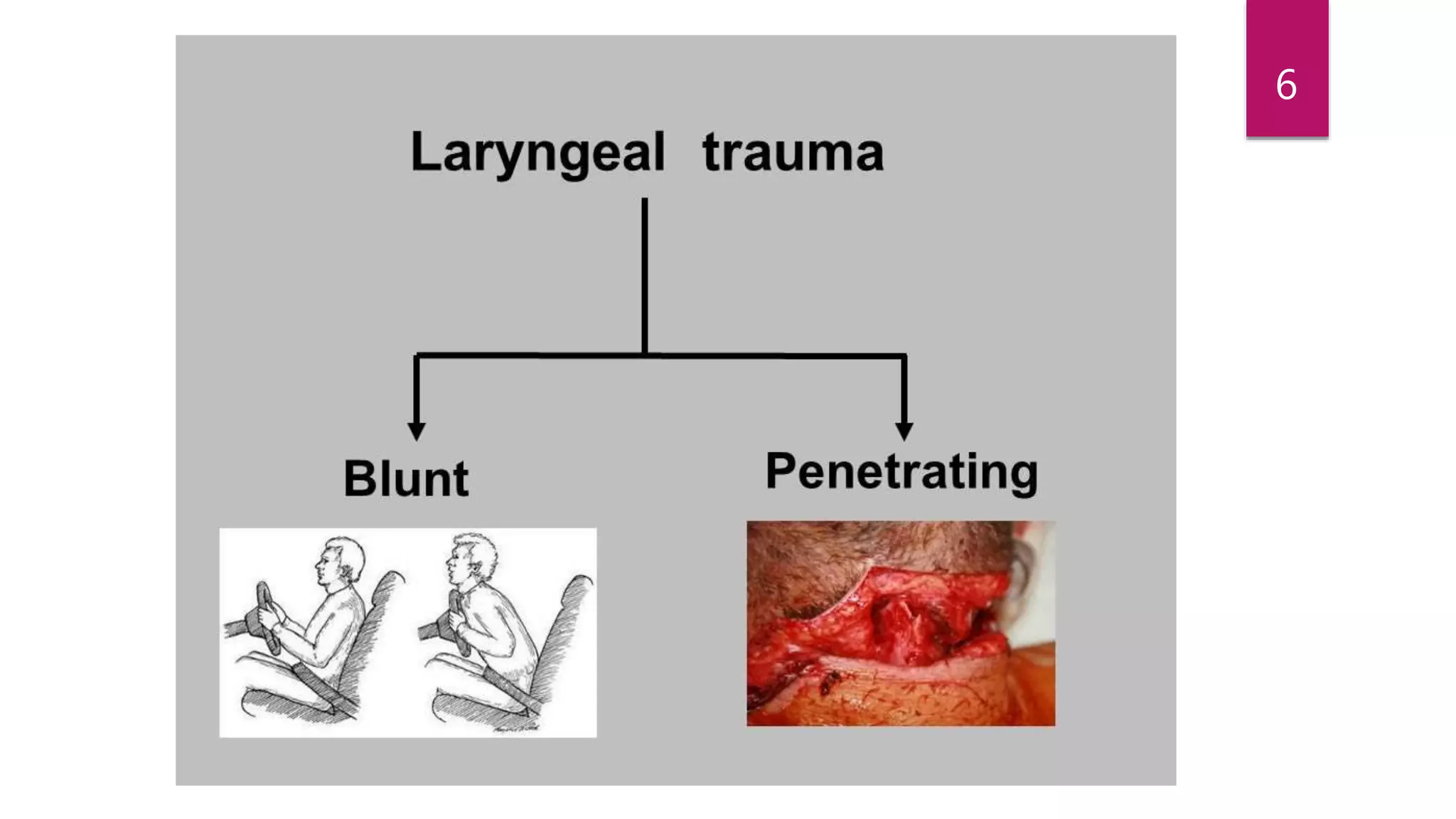 Laryngeal trauma | PPT