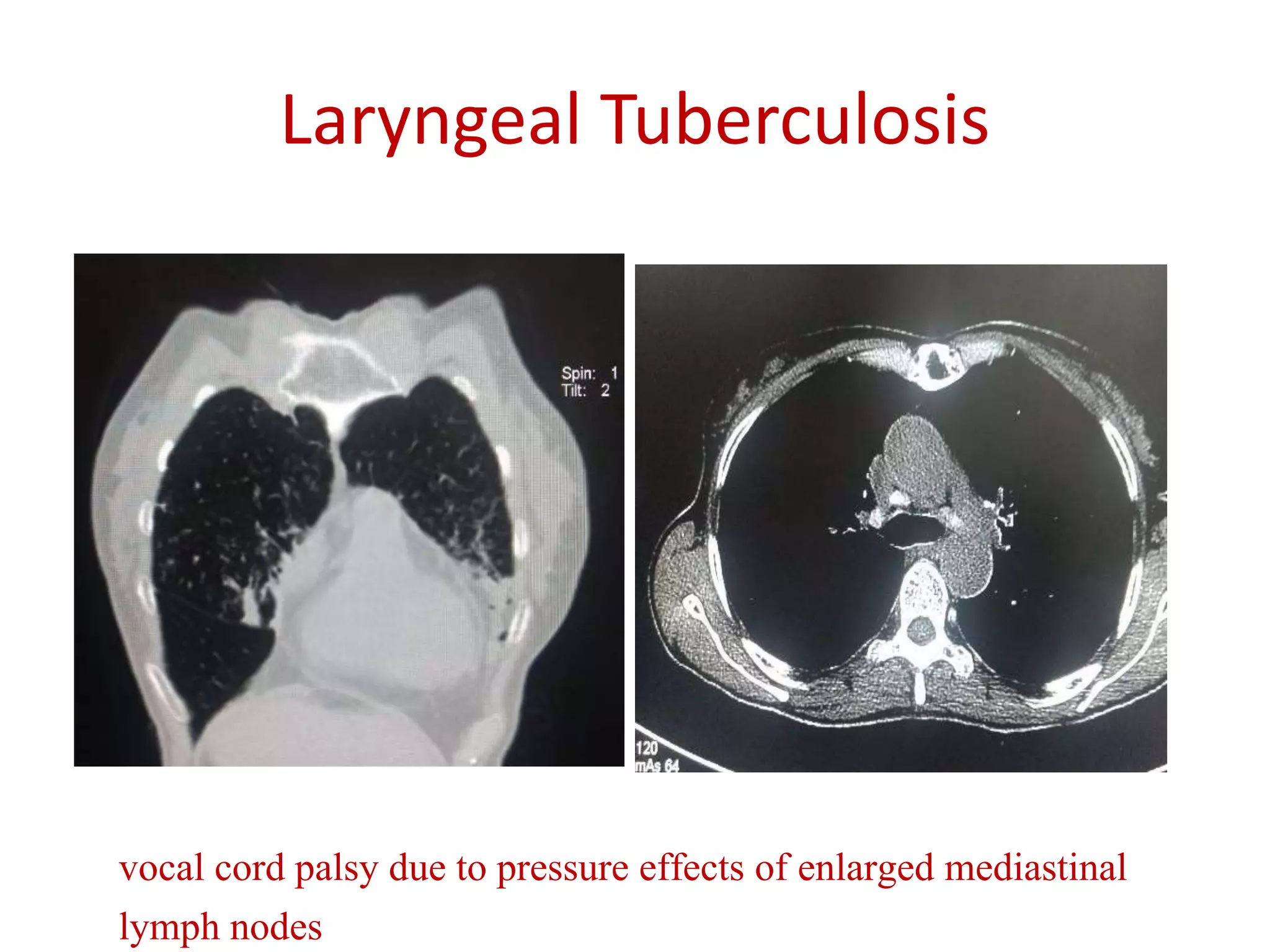 Laryngeal tuberculosis | PPTX