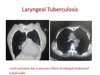 Laryngeal tuberculosis | PPTX