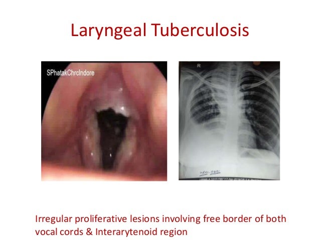 Laryngeal tuberculosis