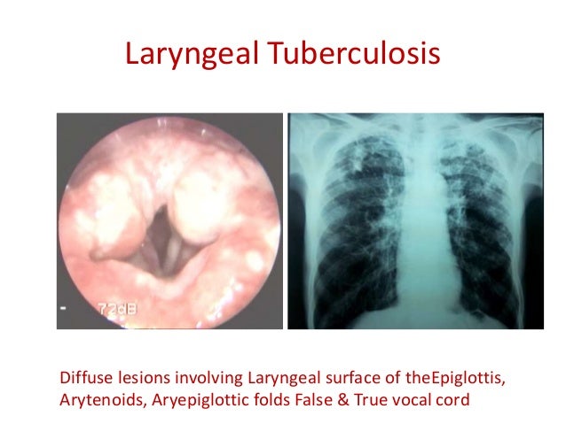 Laryngeal tuberculosis
