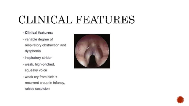 LARYNGEAL WEBS AND SUBGLOTTIC HEMANGIOMA.pptx | Web Development | Internet