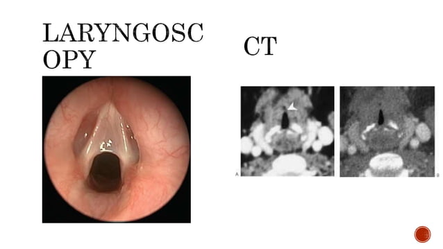 LARYNGEAL WEBS AND SUBGLOTTIC HEMANGIOMA.pptx | Web Development | Internet