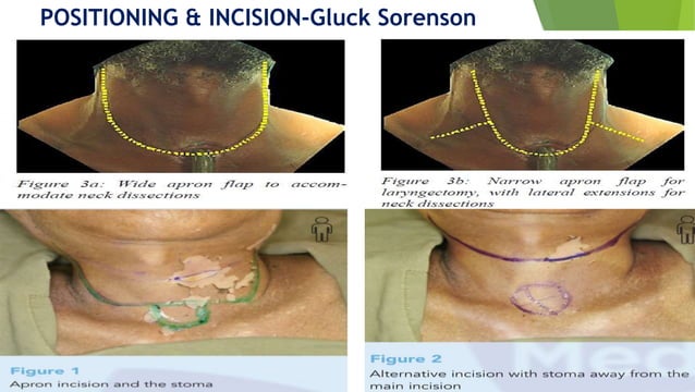 Laryngectomy and post laryngectomy rehabilitation | PPTX