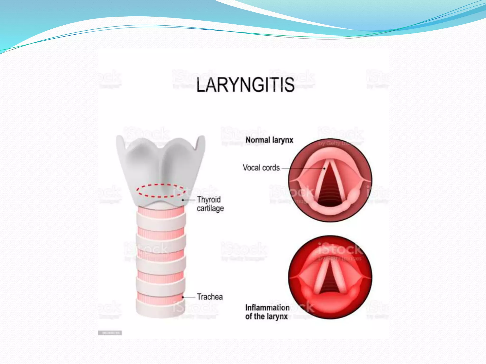 LARYNGITIS.pptx