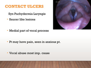 acute and chronic Laryngitis and lesions.ppt