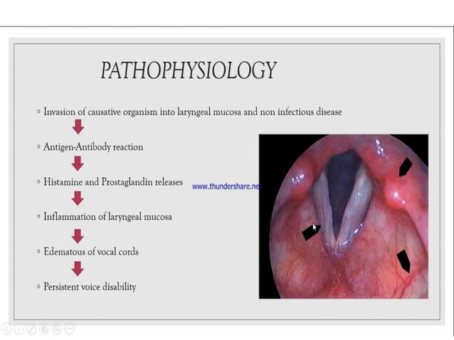 laryngitis ahn.adult health nursing adult | PPTX
