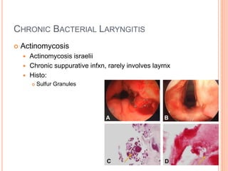Laryngitis | PPTX