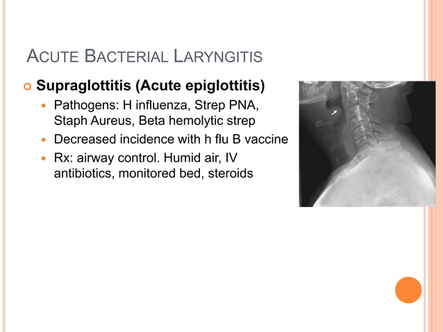 Laryngitis | PPTX