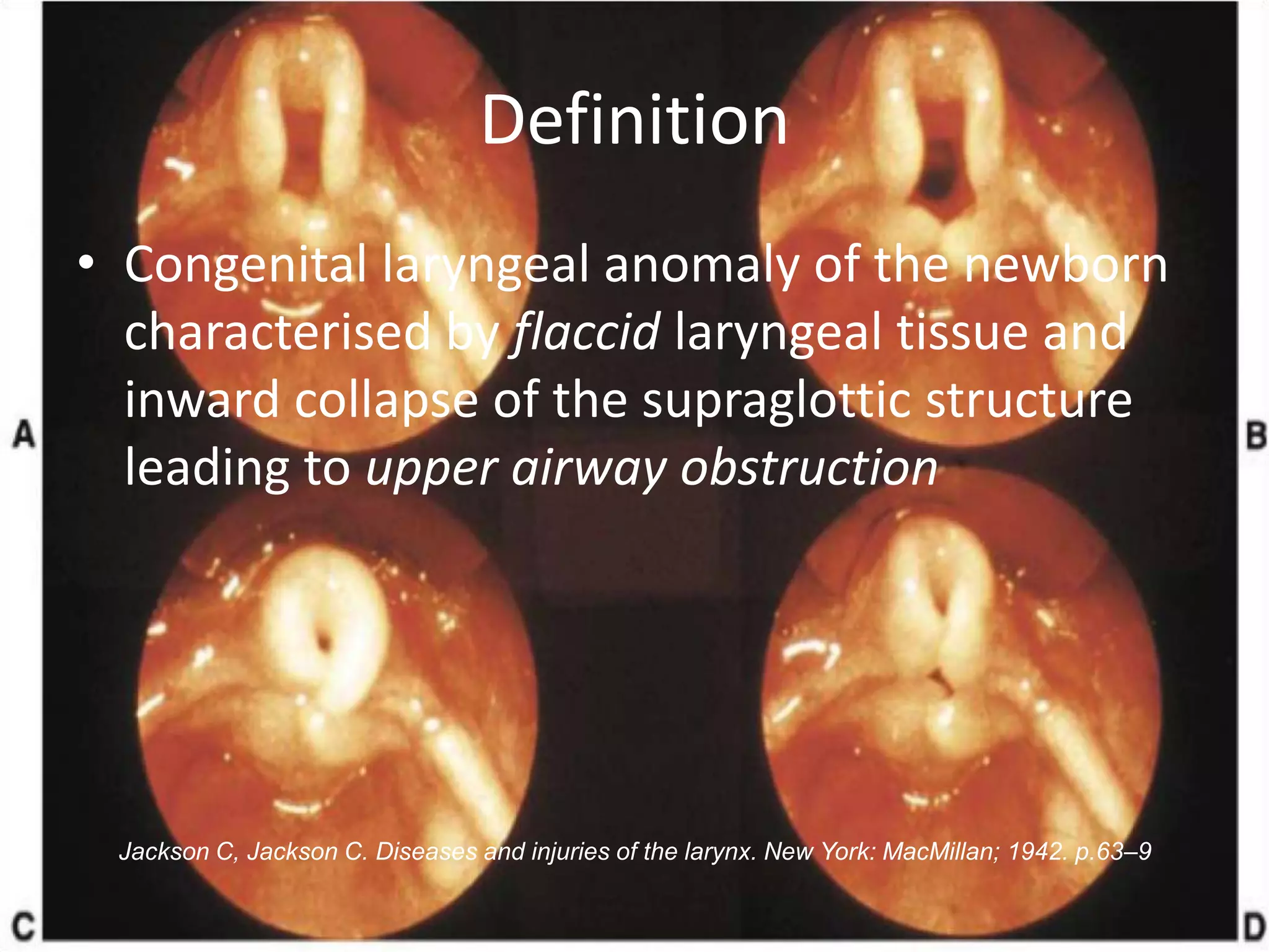 Laryngomalacia | PPTX