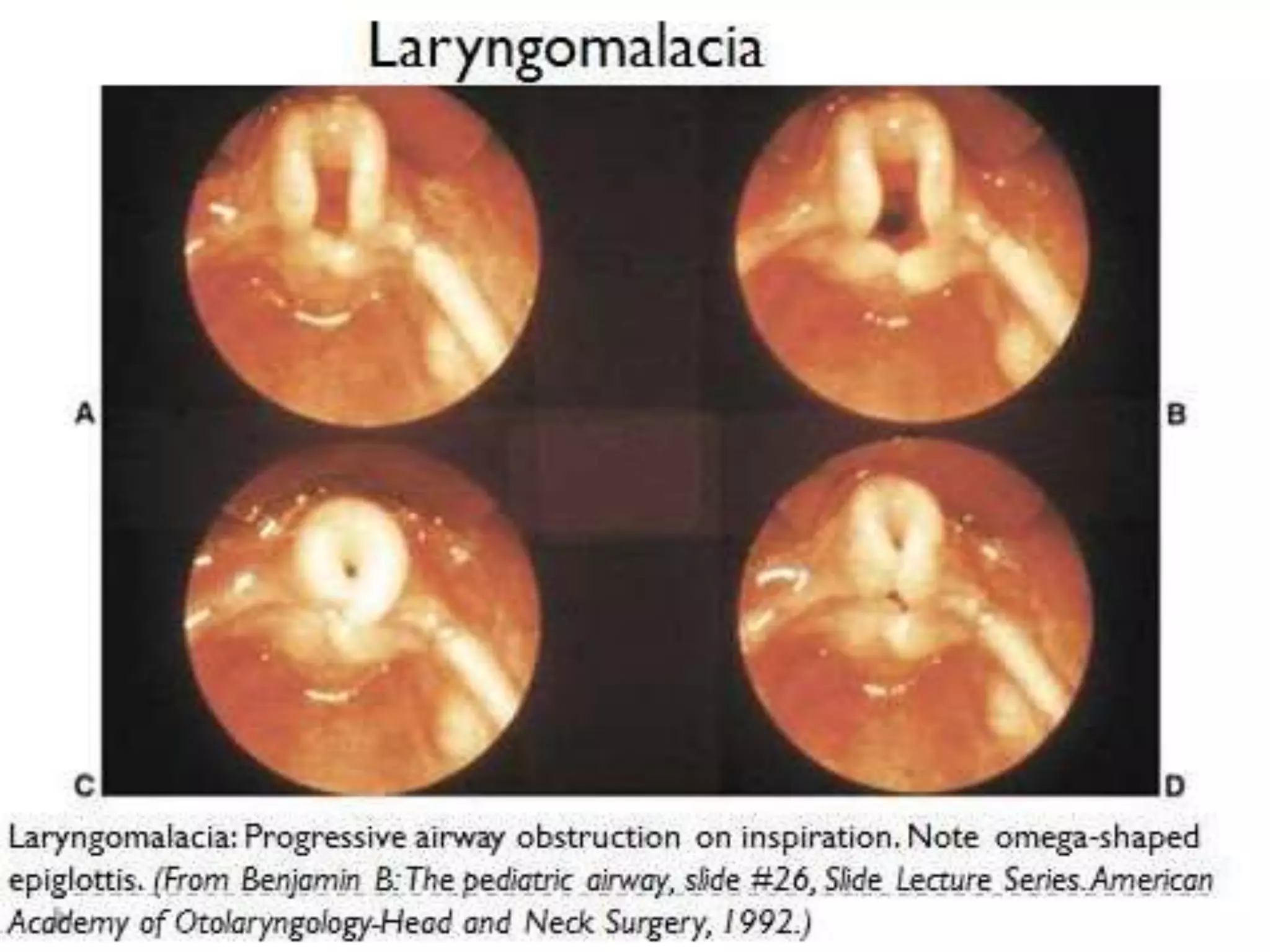 laryngomalacia.pptx