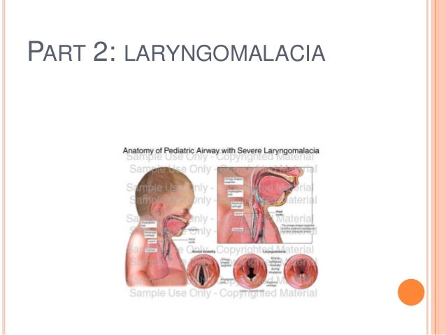 Laryngomalacia BY ZAINAB AHMED