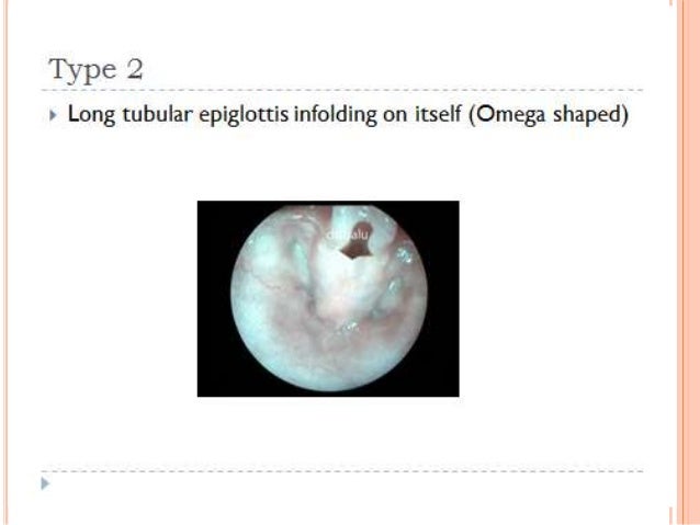 Laryngomalacia BY ZAINAB AHMED