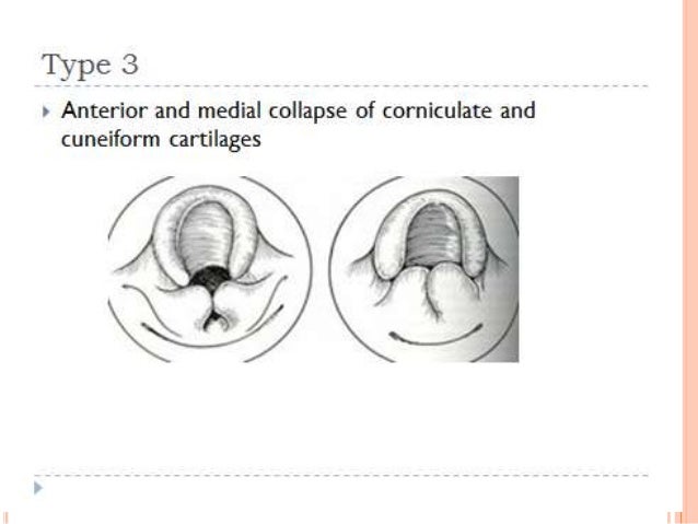 Laryngomalacia BY ZAINAB AHMED