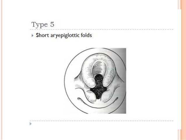 Laryngomalacia BY ZAINAB AHMED