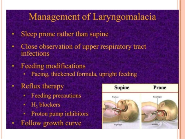 Laryngomalacia BY ZAINAB AHMED