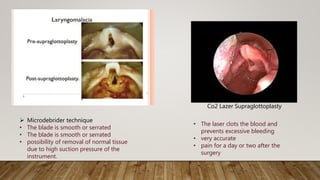 Laryngomalcia | PPTX