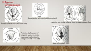 Laryngomalcia | PPTX