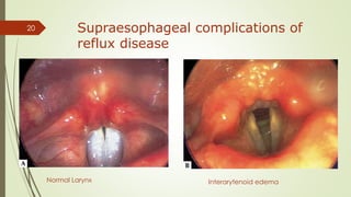 Laryngopharyngeal reflux | PPTX