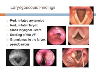 Laryngo pharyngeal reflux (lpr) | PPTX | Ear, Nose and Throat Conditions | Diseases and Conditions
