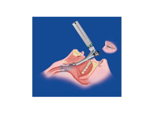 Laryngoscope | PPTX