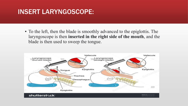 LARYNGOSCOPE pp.pptx | Ear, Nose and Throat Conditions | Diseases and ...