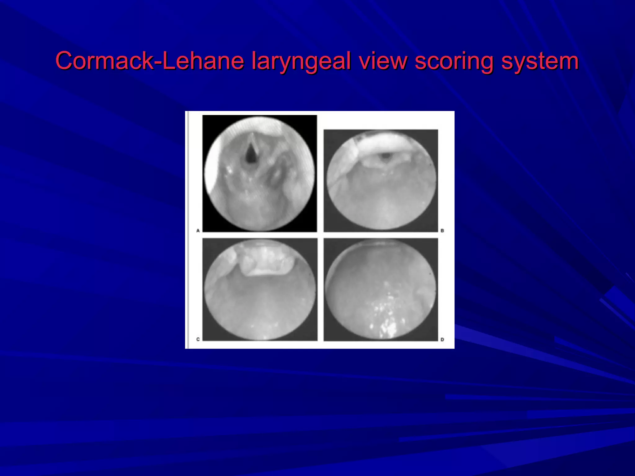 Laryngoscopy | PPT