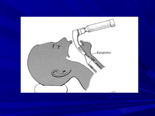 Laryngoscopy | PPT