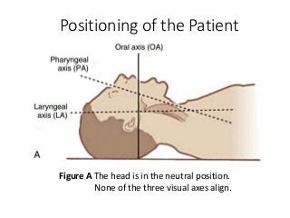 Laryngoscopy & complications | PPTX