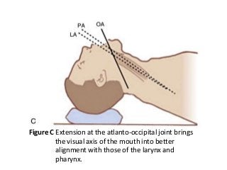 Laryngoscopy & complications | PPTX