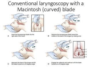 Laryngoscopy & complications | PPTX