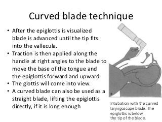 Laryngoscopy & complications | PPTX