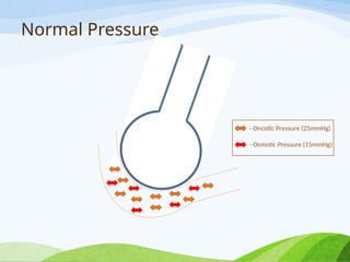 Laryngospasm and -ve pressur pulmonary edema.ppt