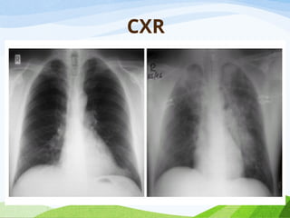 Laryngospasm and -ve pressur pulmonary edema.ppt