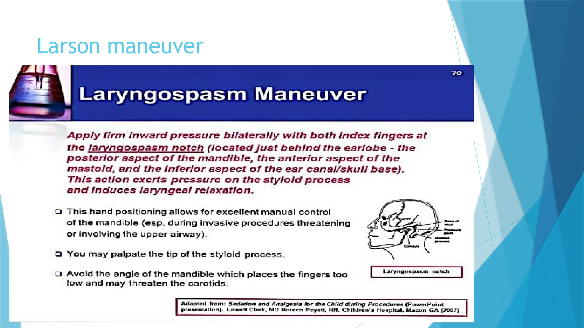 Laryngospasm management dr.siva (1).pptx