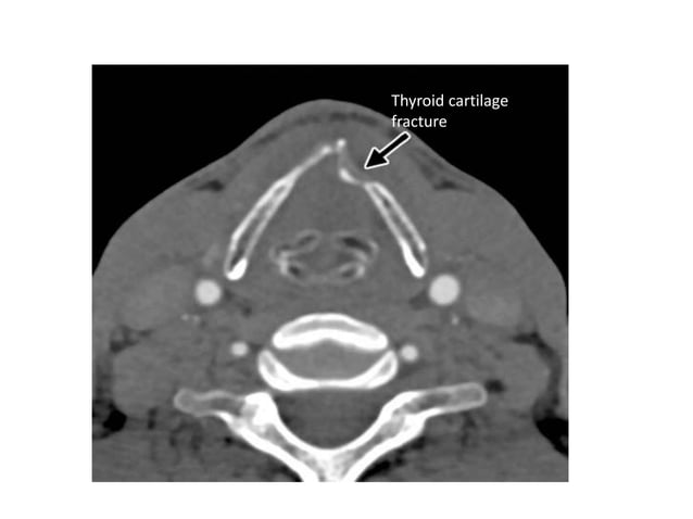 Laryngotracial trauma with anatomy and management | PPTX