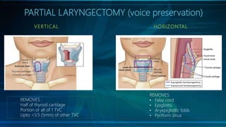 Larynx | PPTX
