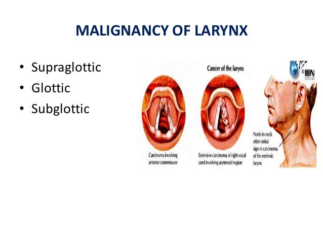 Larynx Glottis Cancer