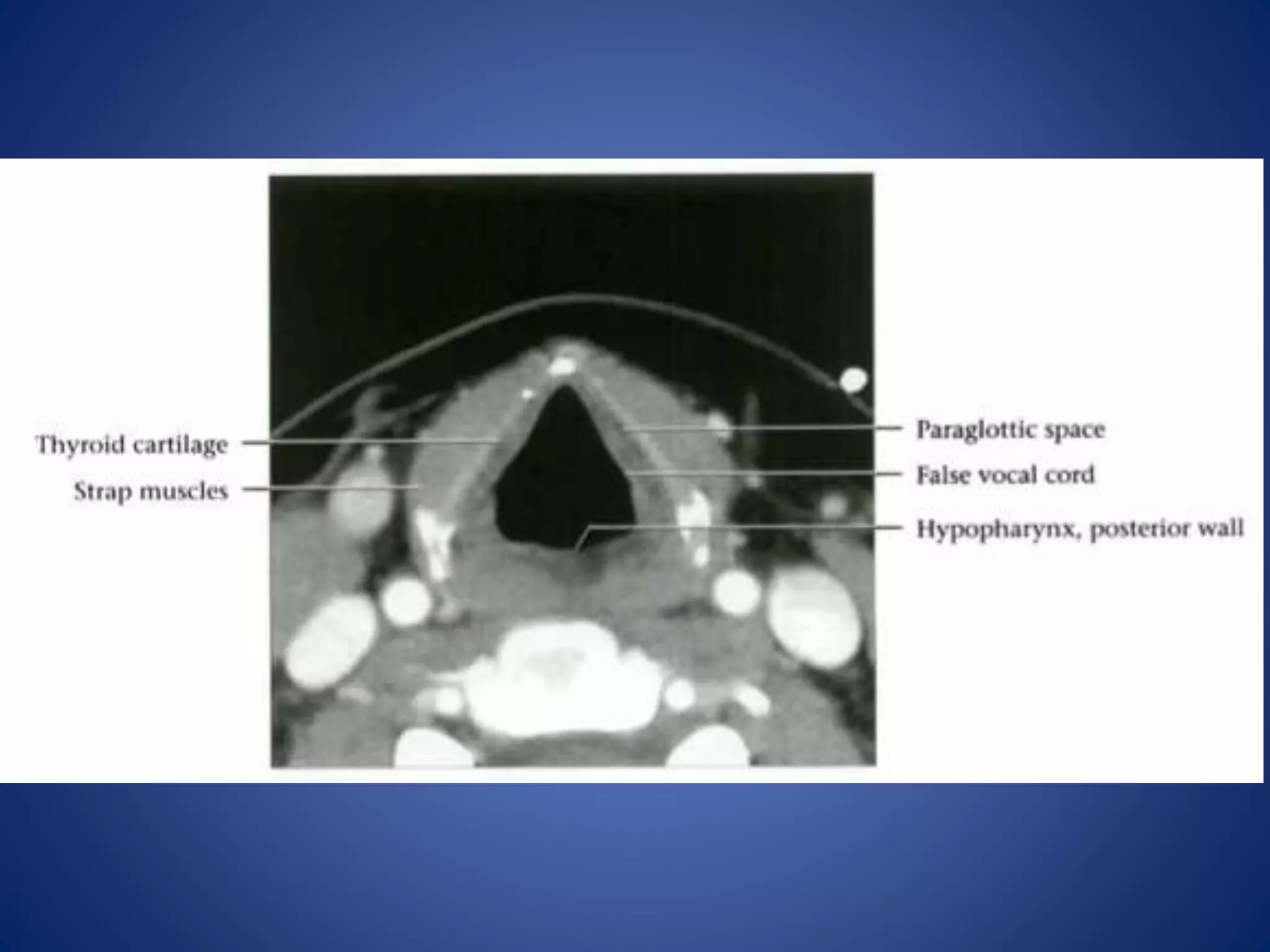 Larynx anatomy and laryngeal ca | PPTX