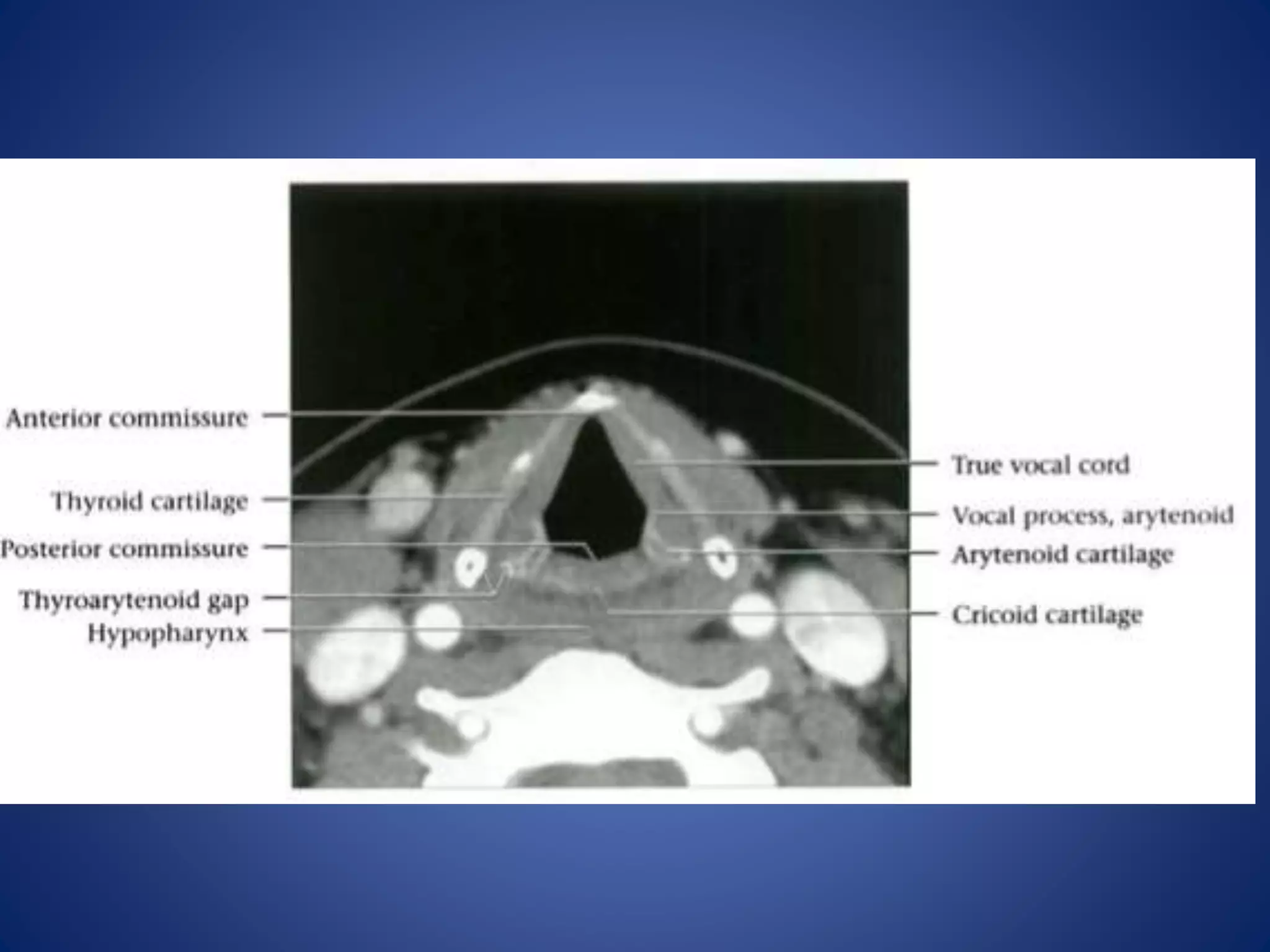 Larynx anatomy and laryngeal ca | PPTX
