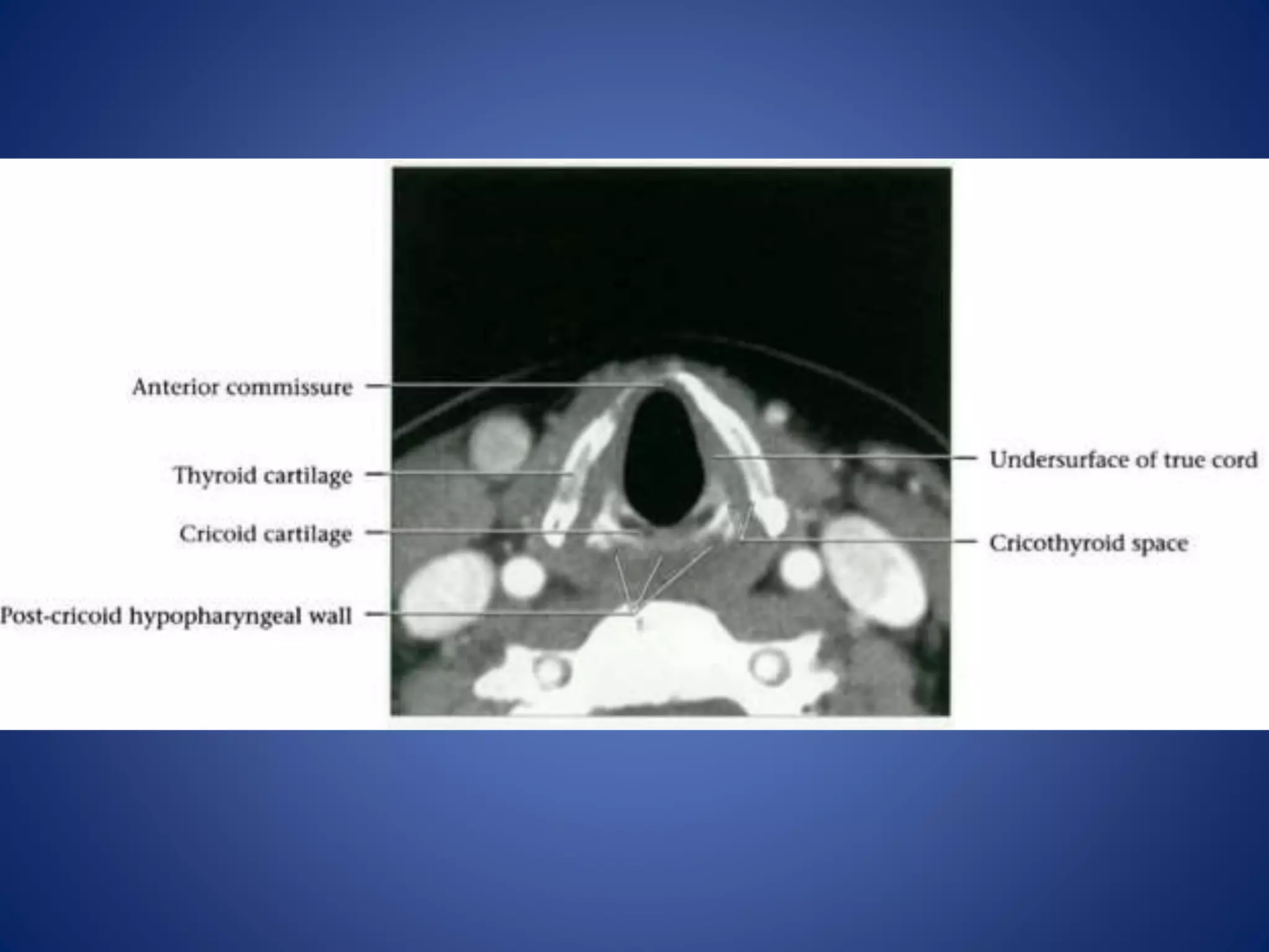 Larynx anatomy and laryngeal ca | PPTX