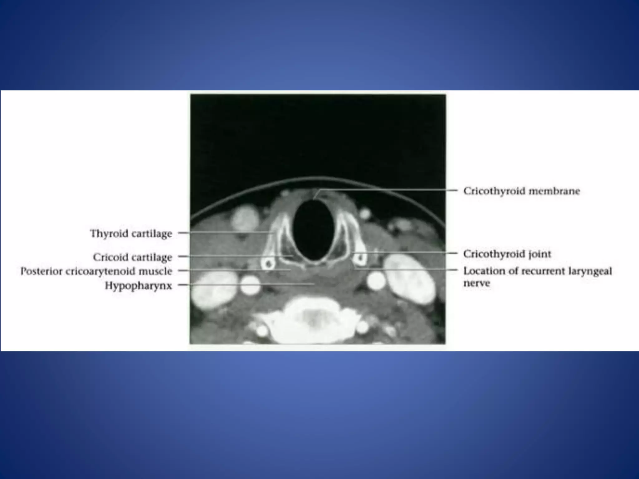 Larynx anatomy and laryngeal ca | PPTX