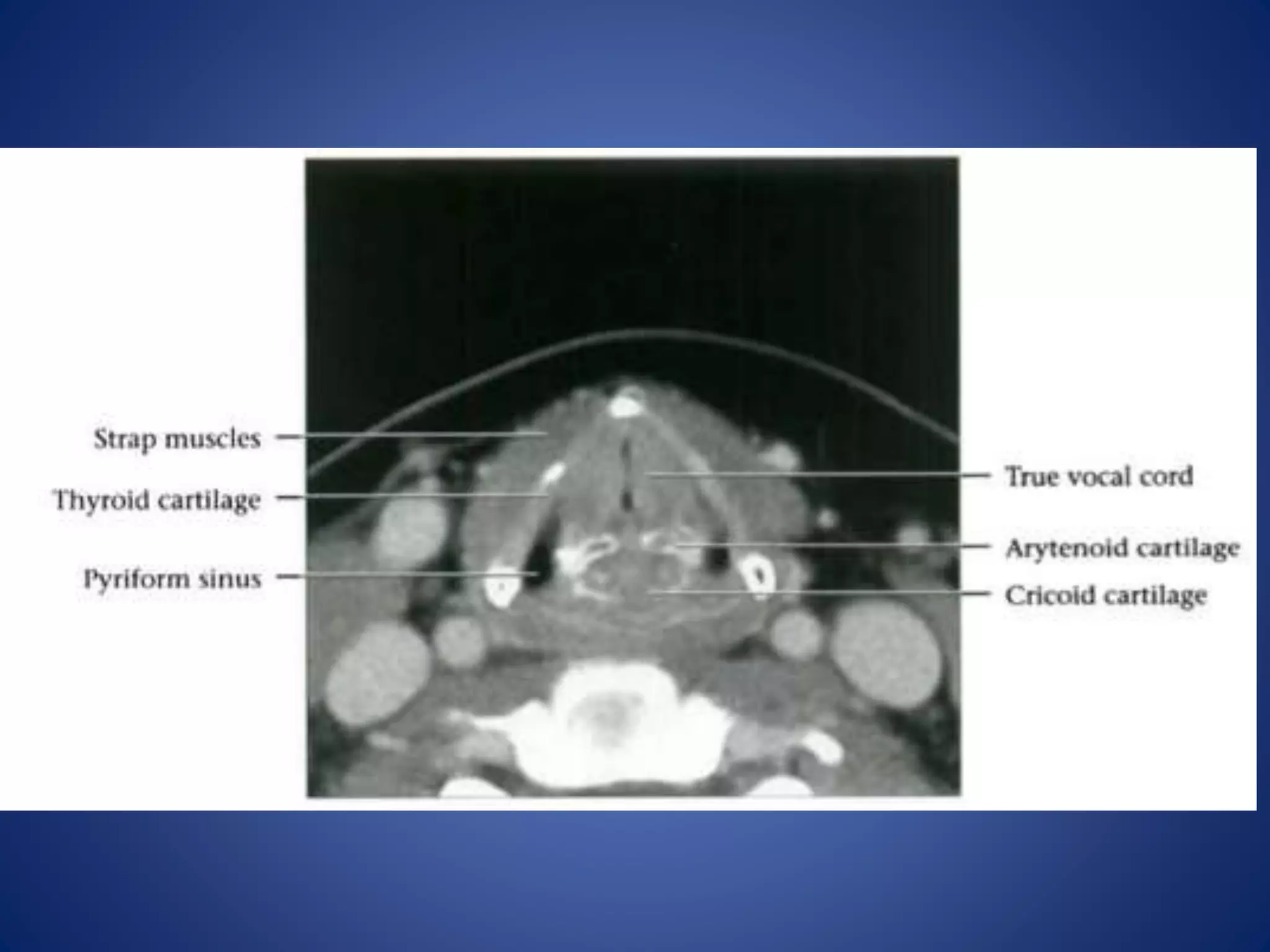 Larynx anatomy and laryngeal ca | PPTX