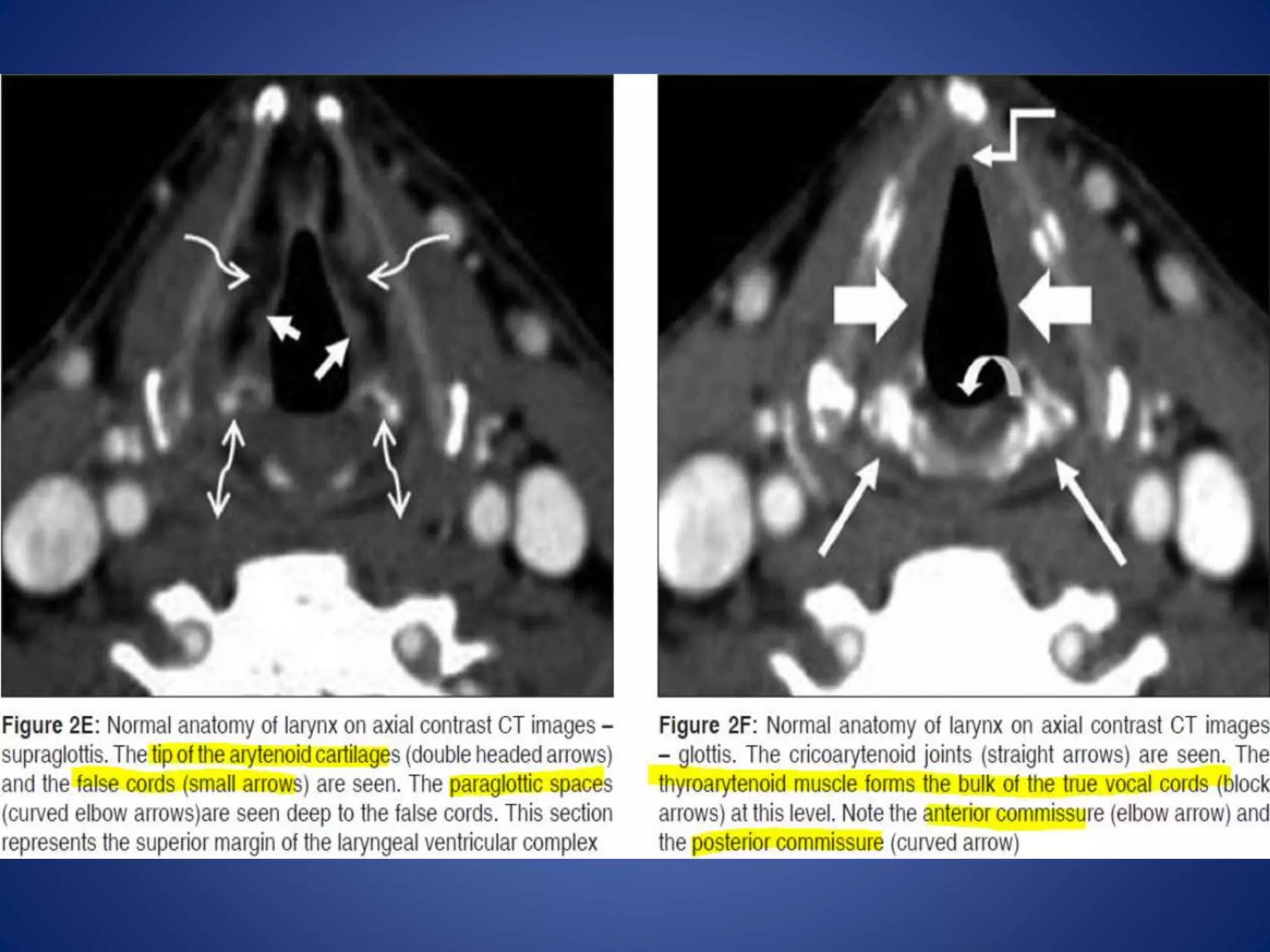 Larynx anatomy and laryngeal ca | PPTX