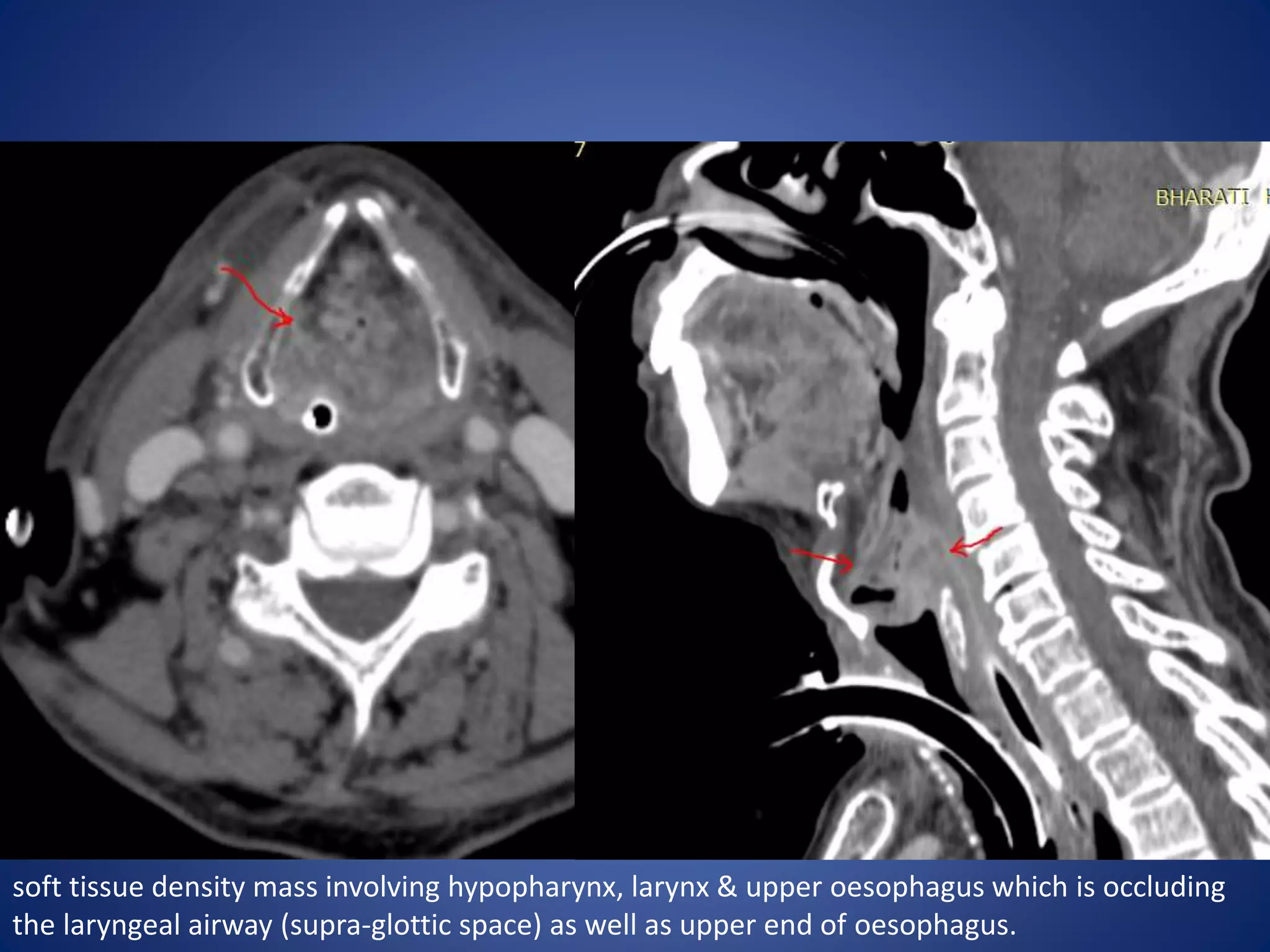Larynx anatomy and laryngeal ca | PPTX