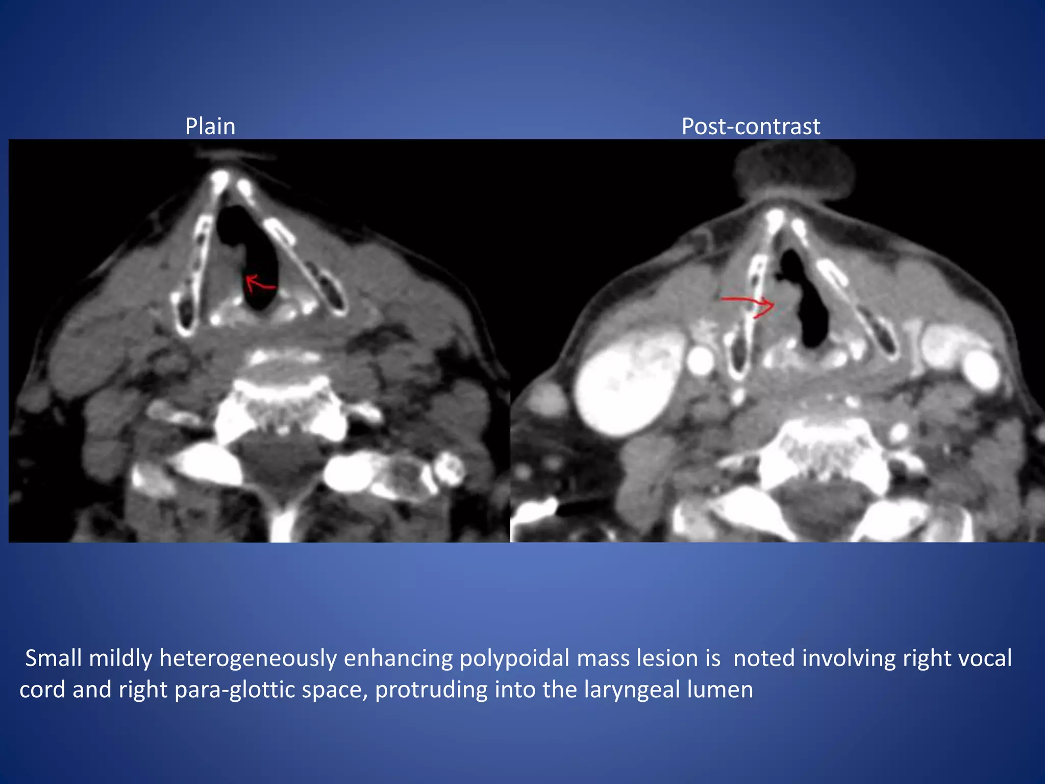 Larynx anatomy and laryngeal ca | PPTX | Thyroid Disorders | Endocrine ...